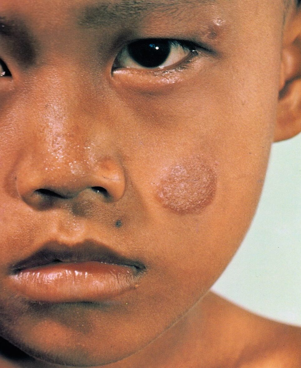 What does leprosy look like? - The Leprosy Mission Myanmar